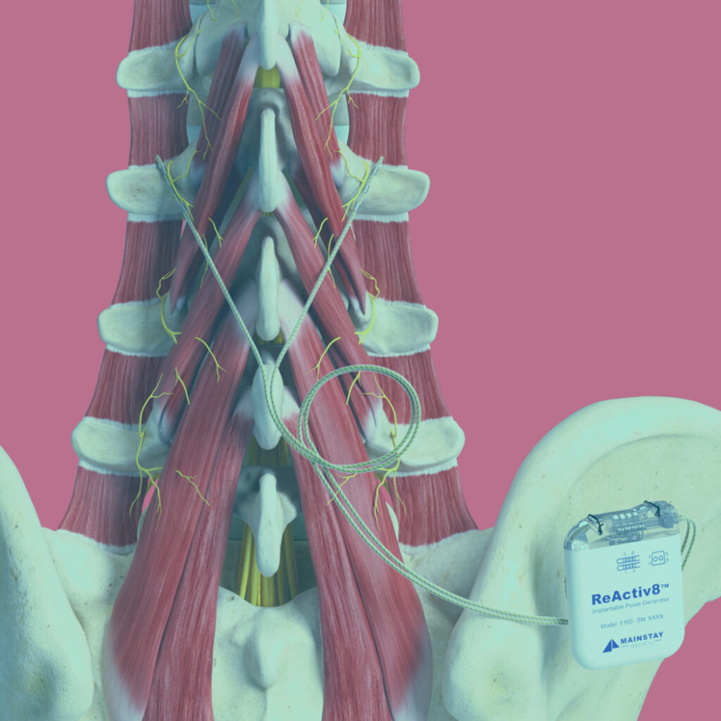 Restaurative Neurostimulationstherapie der Lendenwirbelsäule mit dem ...